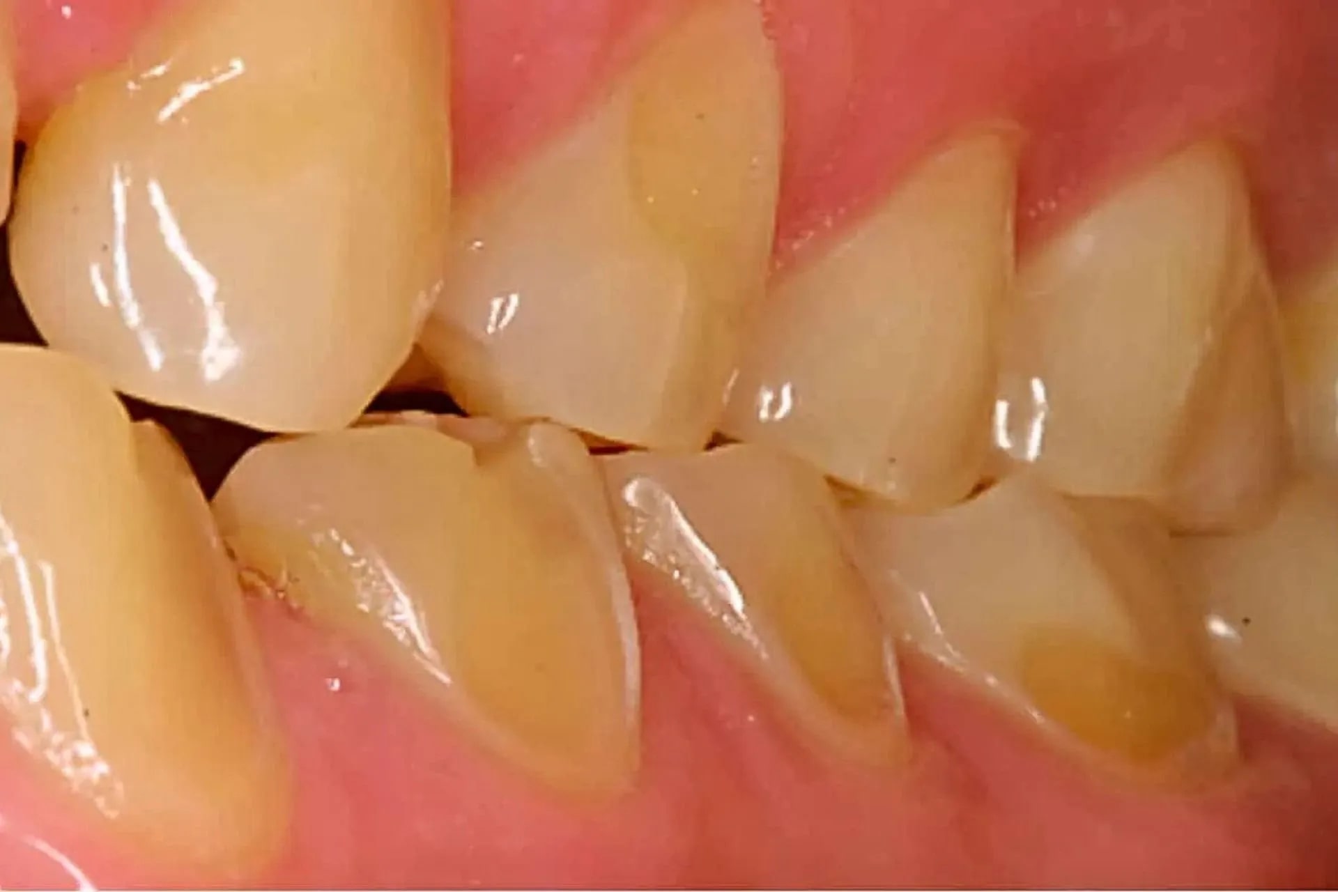 Tanderosie: Oorzaak, Herkennen, Herstellen & Behandeling ...